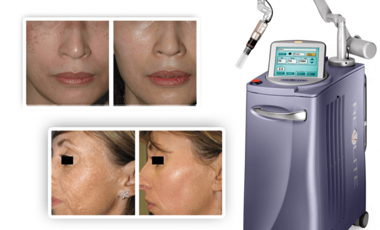 Skin Bleaching Malaysia - Permanent & Effective Solutions (All Skin Types)