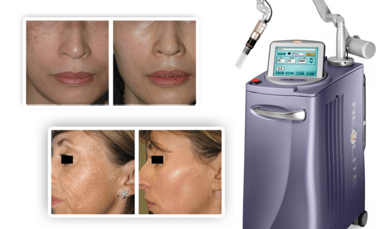 Skin Bleaching Malaysia - Permanent & Effective Solutions (All Skin Types)