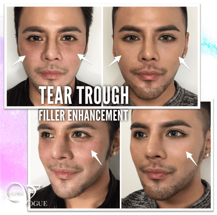 Eye Bag Removal Malaysia - Natural & Non-Surgical Treatment